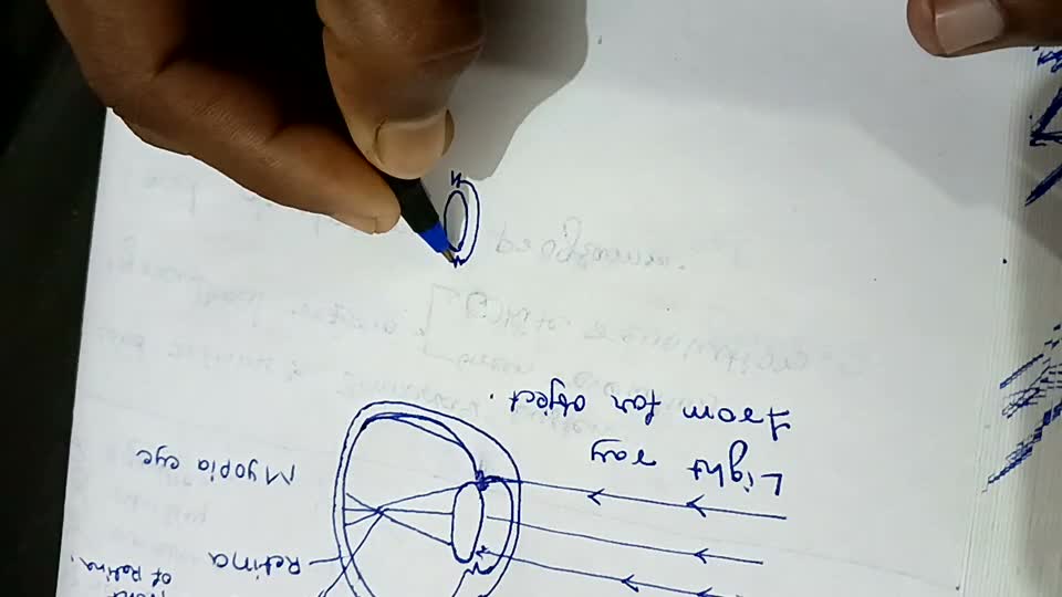 Correction Diagram Of Myopia And Hypermetropia Filo